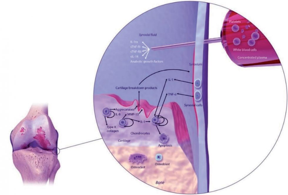 nStride pro odborníky | Injekcedokloubu.cz